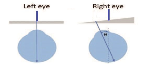 Understanding Squints, Eye Turns, Prismatic Lenses, Tired Eyes ...